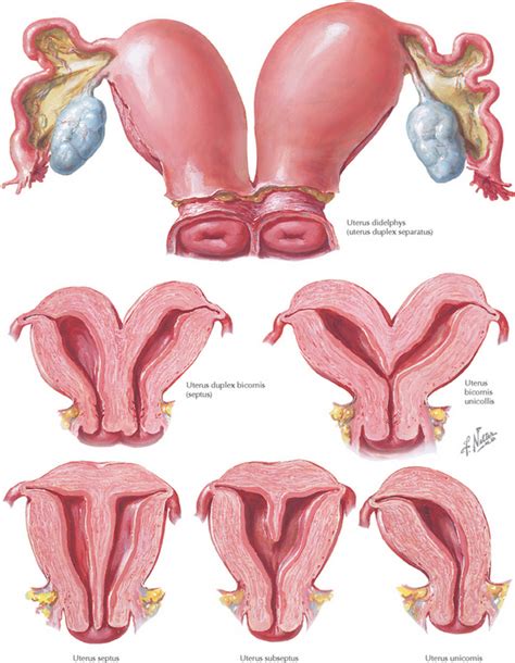 Pdf Primary Vaginal Adenocarcinoma With Bicornuate Bicollis Uterus