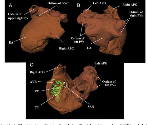 Figure 1 From Preventive Ablation Strategies In A Biophysical Model Of Atrial Fibrillation Based