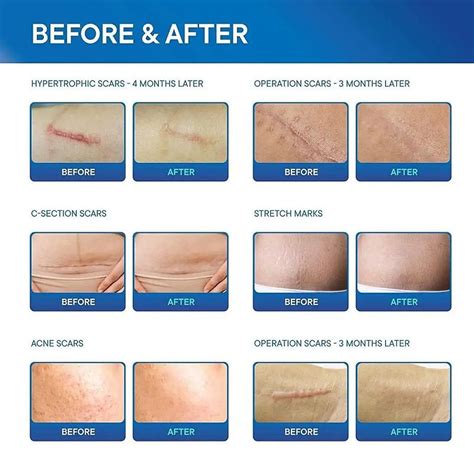 Adhesive Silicone Gel Scar Sheet Dressing For Best Scar Treatment