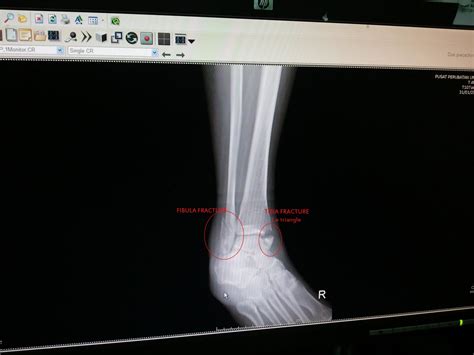 Kokenko Tibia And Fibula Fracture