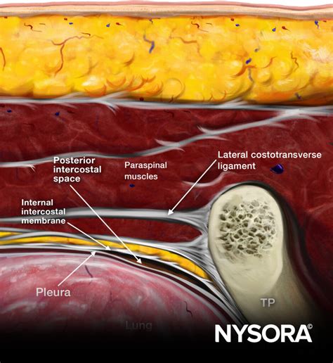 Tips For The Thoracic Paravertebral Block Transverse Scan Nysora