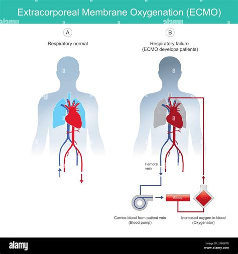 Extracorporeal Membrane Oxygenation