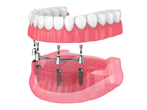 Understanding Bar Attachment Dentures An Introduction St Louis