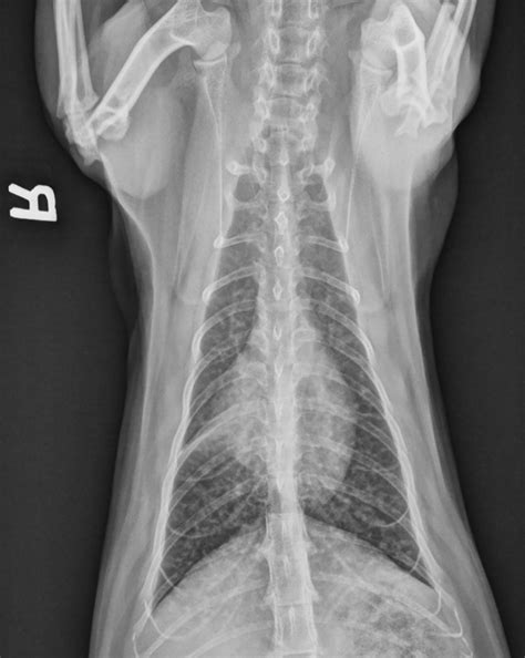 X Ray Of Lungs With Asthma