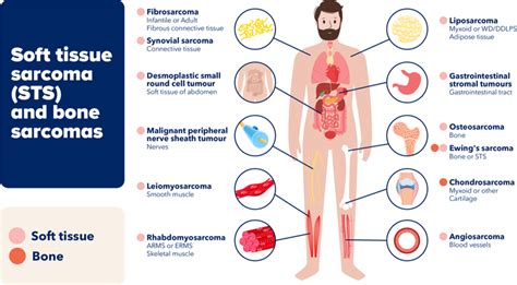 Increasing Prevalence Of Synovial Sarcoma