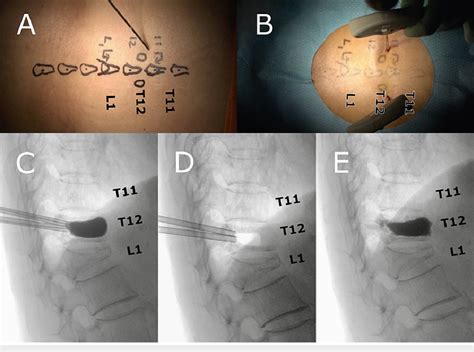 Bkp Reinforced The Anterior Vertebral Element Case 1 In Download
