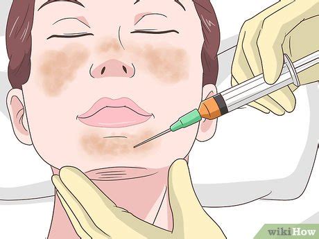 3 Cara Untuk Menghilangkan Melasma WikiHow