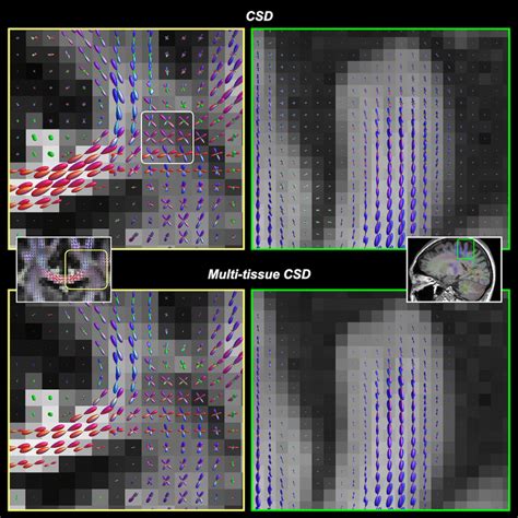 Reconstruction Of Voxel Wise Fodfs Using Csd Upper Row And Download Scientific Diagram