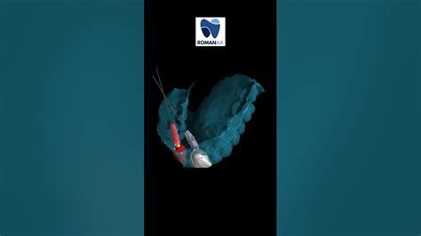 Biohorizon Complete Guided Kit Youtube