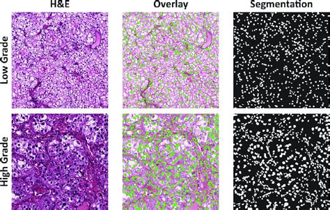 Examples Of Nuclei Detection And Segmentation In Low And High Grade Download Scientific Diagram