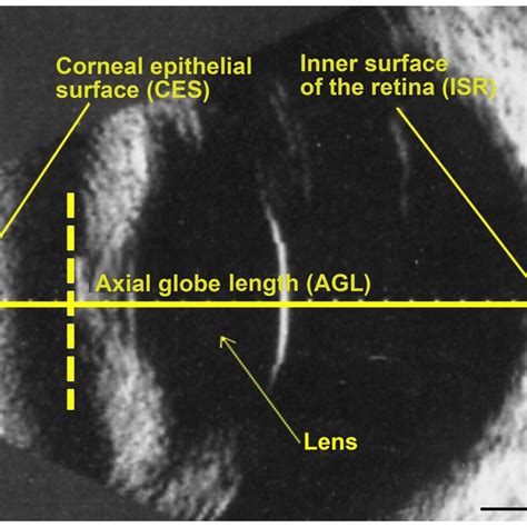 Pectinate Ligament Abnormalities Pla Evaluated By Gonioscopic