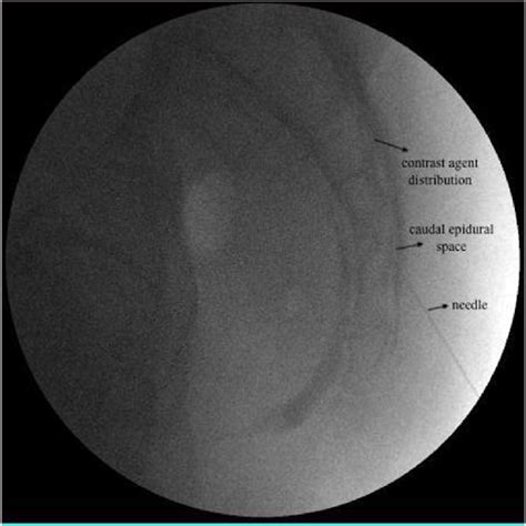 Caudal Epidural Steroid Injection Cesi Lateral Image Download