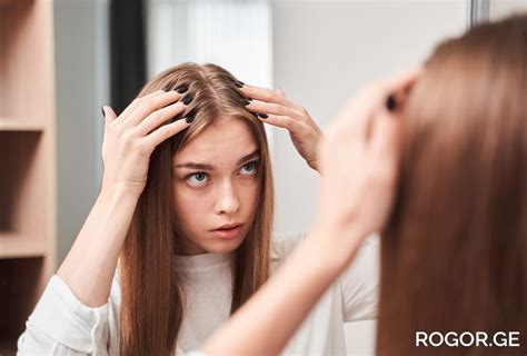 რას ნიშნავს სკალპის აკნე როგორია მისი სიმპტომები და მკურნალობა Rogor Ge