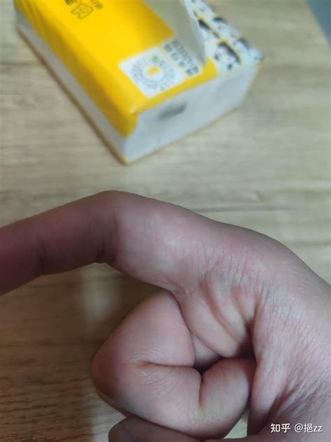 我手指上有一小部分皮肤变白形状就跟小伤疤一样但我并没有受伤现在只有左手中指和无名指有怎么回事 知乎