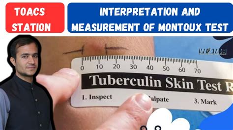 Tuberculin Skin Test Measurement And Interpretation Positive Ppd Montoux Test Patient