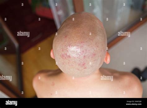 Acne On Bald Head