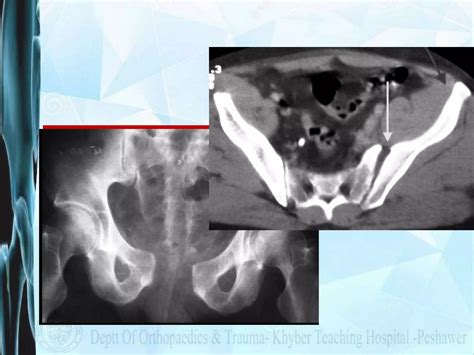 Pelvic Fracture Classification Pptx
