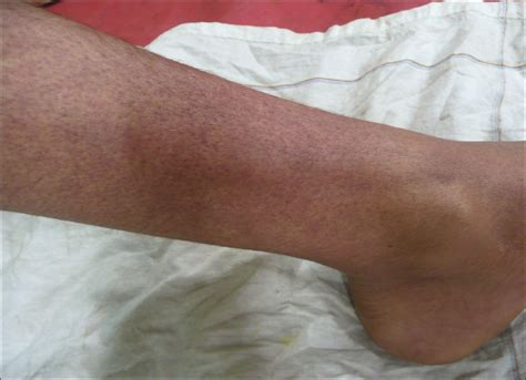 Leptospirosis Rash