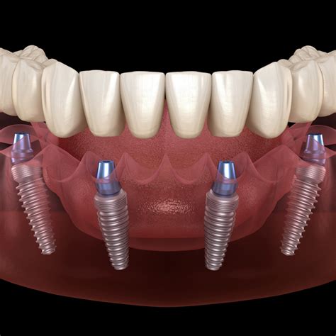 Discover 20 Dental Implants🦷 And Dental Implants Ideas Dental