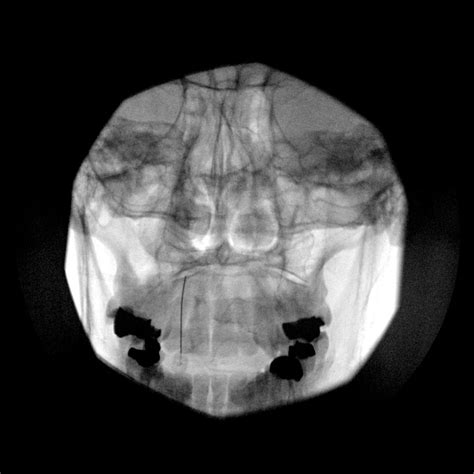 Atlantoaxial C1 C2 Joint Injection Samer Narouze Md Phd