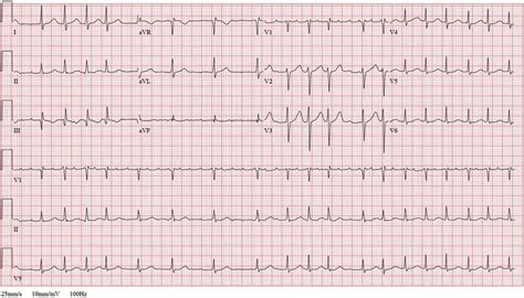 Follow Up Electrocardiogram Demonstrating Atrial Flutter With Variable Download Scientific