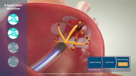 Farapulse™ Pulsed Field Ablation System Workflow Introduction Youtube