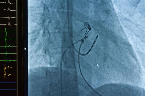 Cardiac Ablation — Dr Young Yu · Cardiologist · Sydney