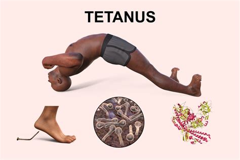 Tetanus Defence 101 How To Protect Yourself From This Serious