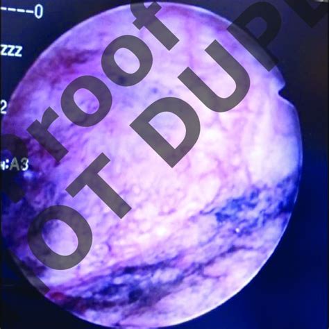 Diffuse Melanosis In A Mucosal Lamina Propria And In B High Grade