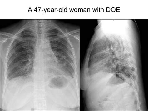 Diffuse Alveolar Damage Ppt