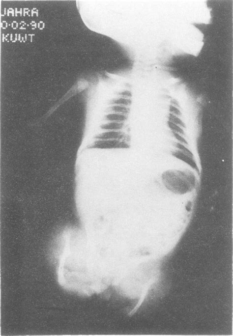 X Ray Showing Multiple Contracture Deformities Download Scientific