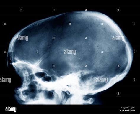 Coloured X Ray Side View Of The Elongated Skull Dolichocephalic