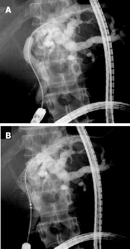 Figure 1 From Partial Stent In Stent Placement Of Biliary Metallic Stents Using A Short Double