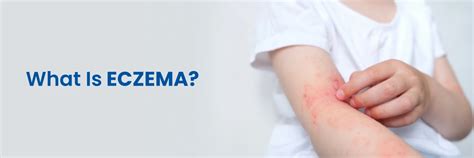 Eczema Tipi Cause Sintomi E Trattamento