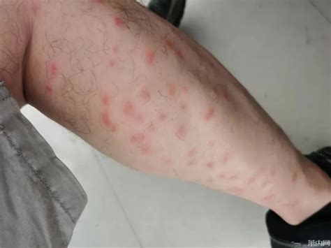 比蚊子还毒被咬后奇痒无比长时间难以消退多人中招 新闻中心 温州网