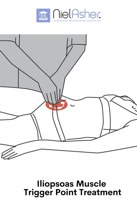 Subscapularis Muscle Trigger Point Treatment Artofit