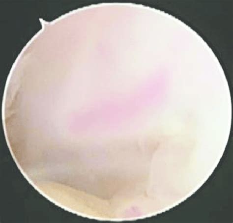 Mcp Inflammatory Arthropathy Preoperatively Download Scientific Diagram