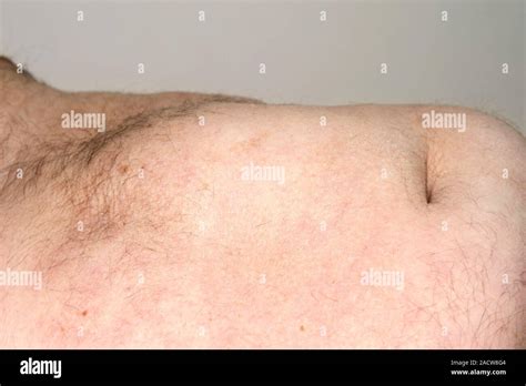 Abdominal Hernia Close Up Of The Abdomen Of An 66 Year Old Male Patient With A Hernia A Hernia