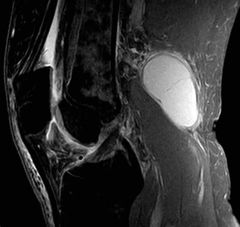 Popliteal Lymph Nodes Mri