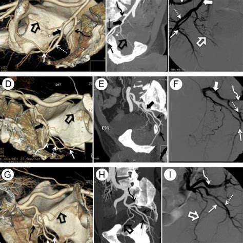 Pdf Radiological Anatomy Of Prostatic Arteries