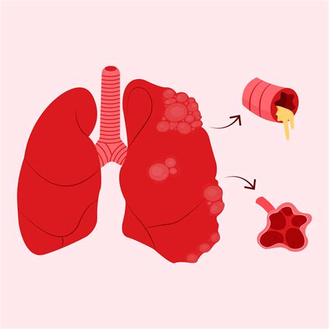 Illustration Of A Diseased Lung Affected By Copd Or Chronic Obstructive