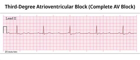 Ecg Third Degree Atrioventricular Block Complete Av Block 8 Second Ecg Paper Electrocardiography