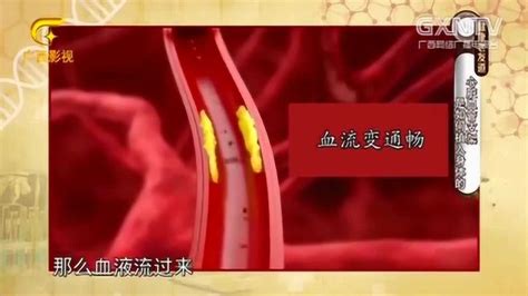 3D动画演示心脏血管支架植入全过程看完视频感觉太神奇 高清1080P在线观看平台 腾讯视频