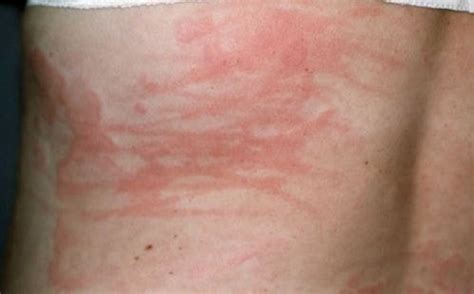 Dermographia Pictures Treatment Causes Symptoms