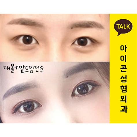 아이콘성형외과 자연유착매몰 앞트임후기 인아웃라인 쌍수6개월차 짝짝이눈 흐릿한눈 에서
