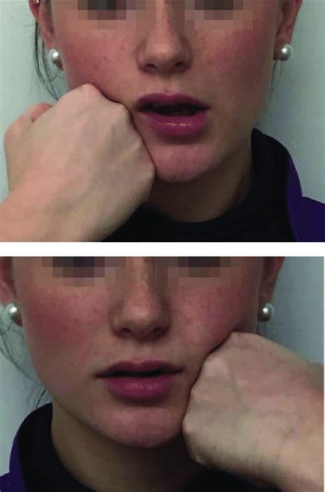 And 6 Contracture Release In Right And Left Lateralities Download