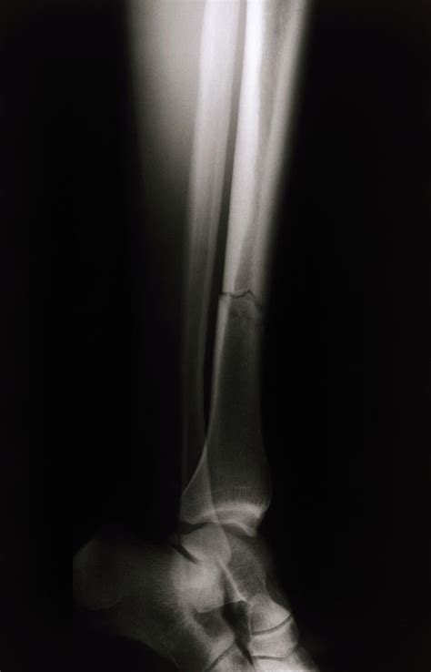 X Ray Of A Break In Leg Tibia Bone By Science Photo Library