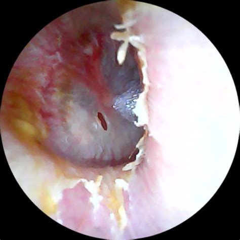 Understanding Decreased Hearing Perforated Eardrum Part 3 Just Ears