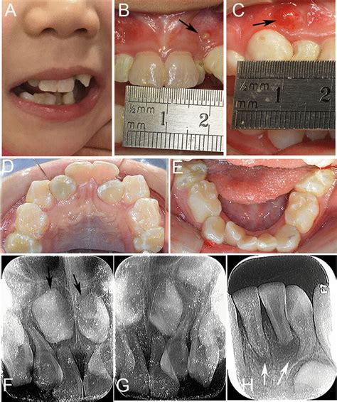 Clinical And Radiographic Features Of Case 1 With Sas A The Extraoral Download Scientific