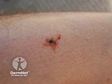Insect Bites And Stings Cme Dermnet New Zealand Insect Bite Images